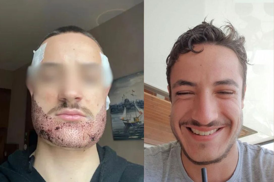 Tragédie après une greffe de barbe en Turquie pour un étudiant français ...